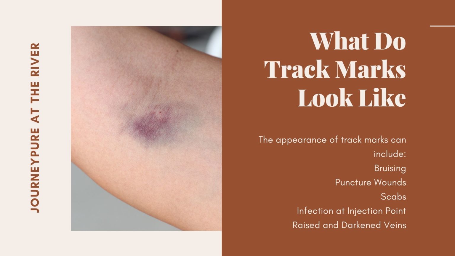 What Are Track Marks On Arms JourneyPure At The River What Are Track Marks On Arms JourneyPure At The River
